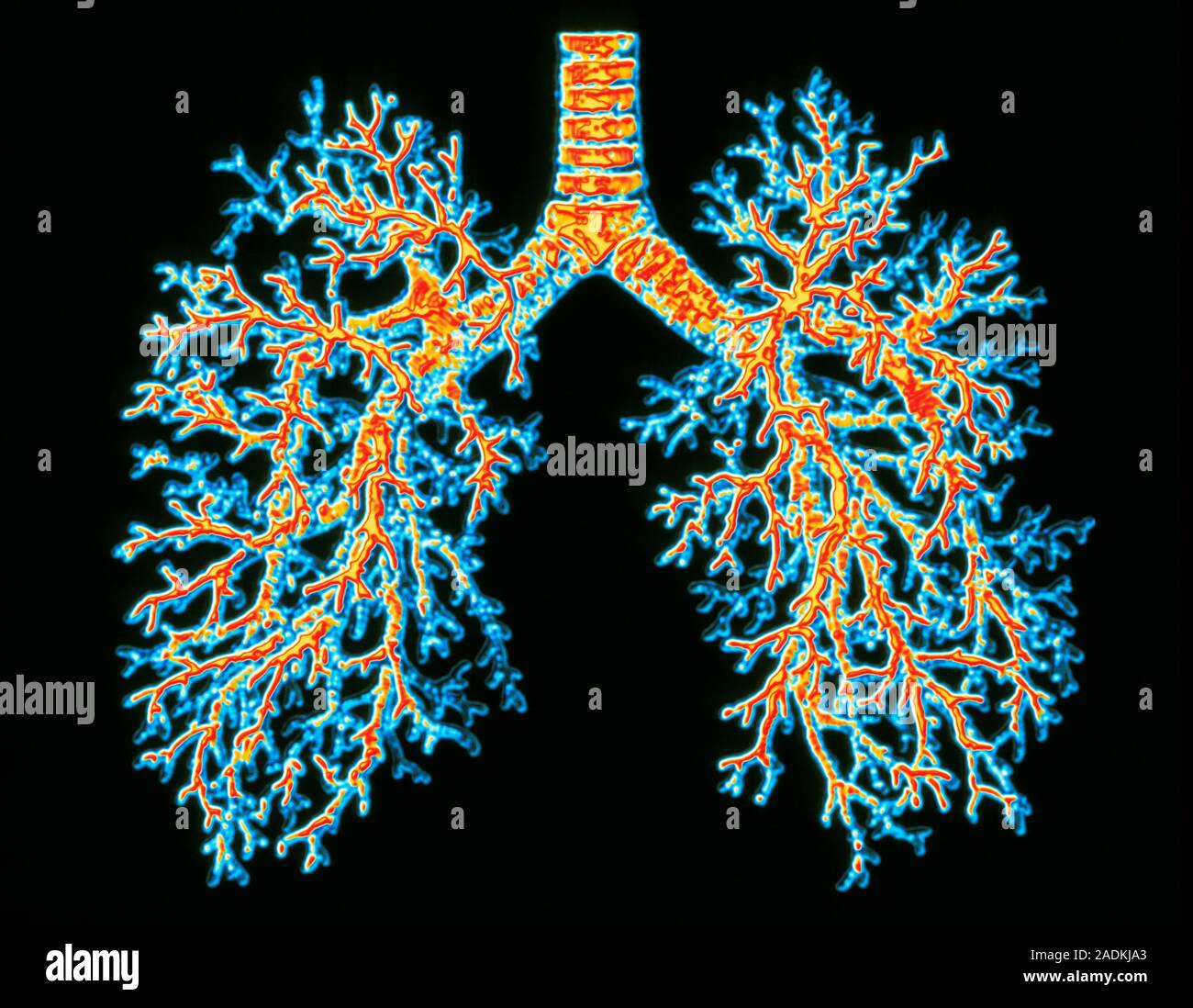 Lung airways. Computer-enhanced image of a resin cast of the airways in ...