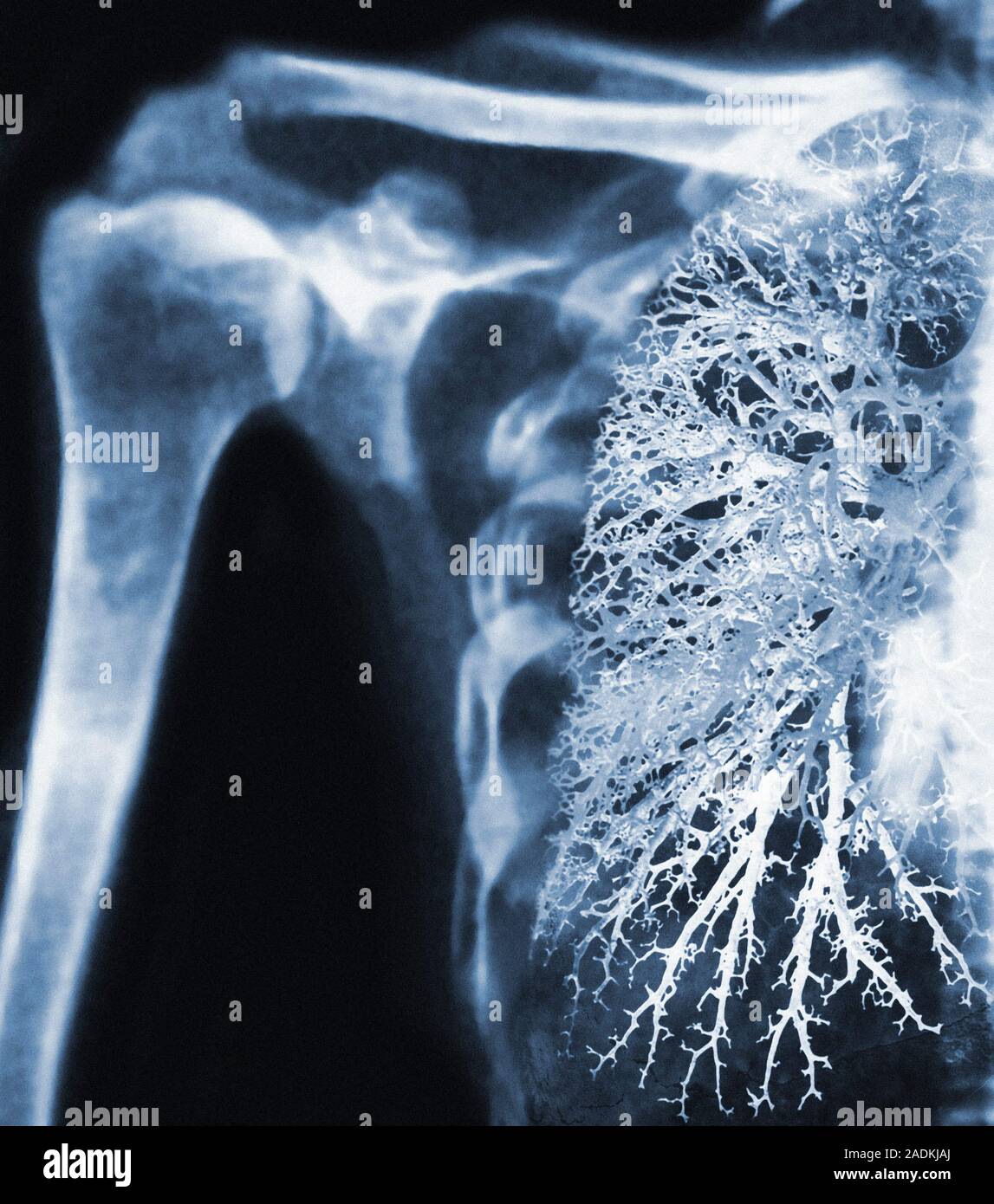 Bronchiole network, composite image. The trachea (windpipe, not seen ...