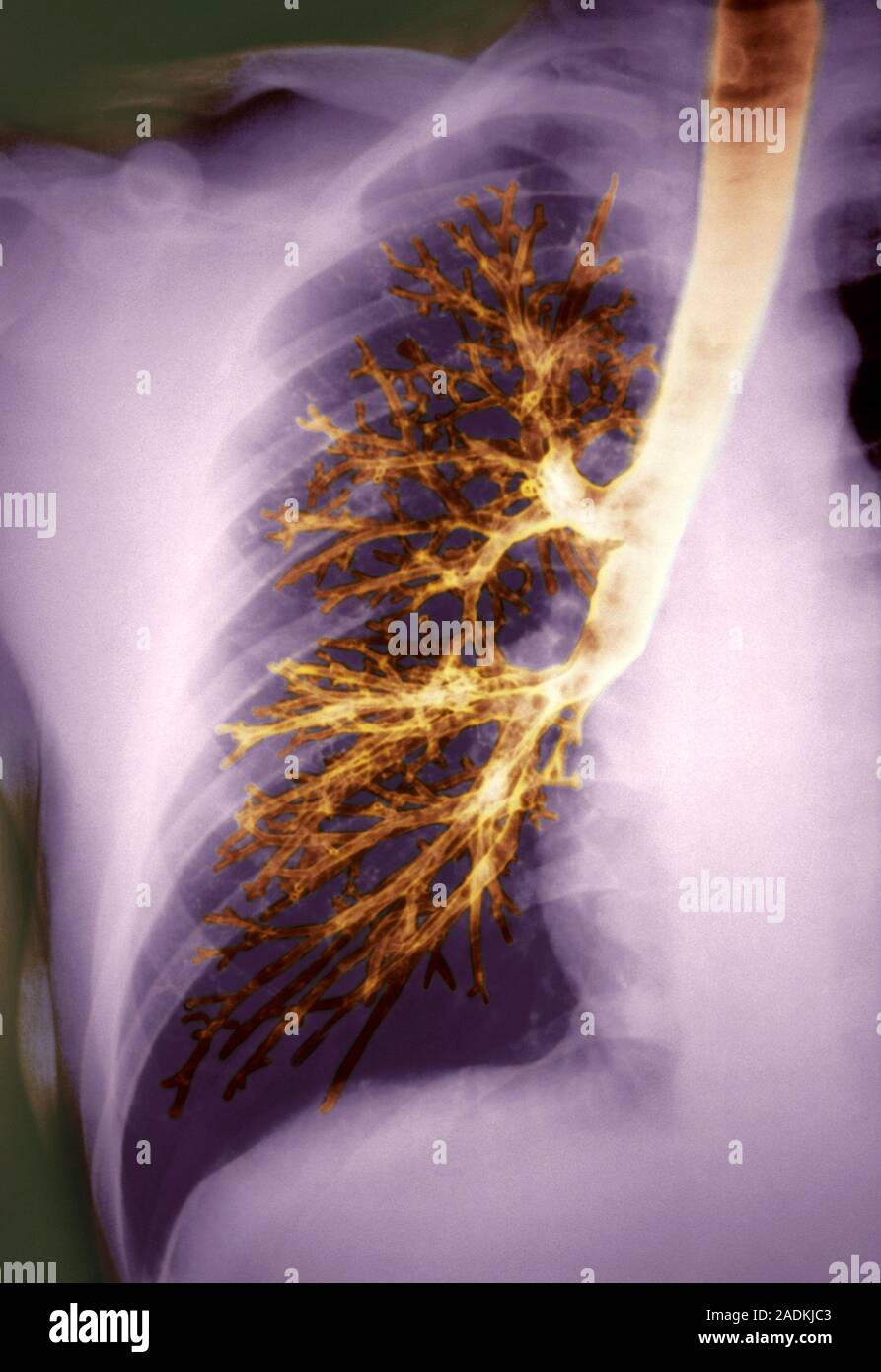 Lung. Coloured bronchography (X-ray) of a healthy human lung. A ...