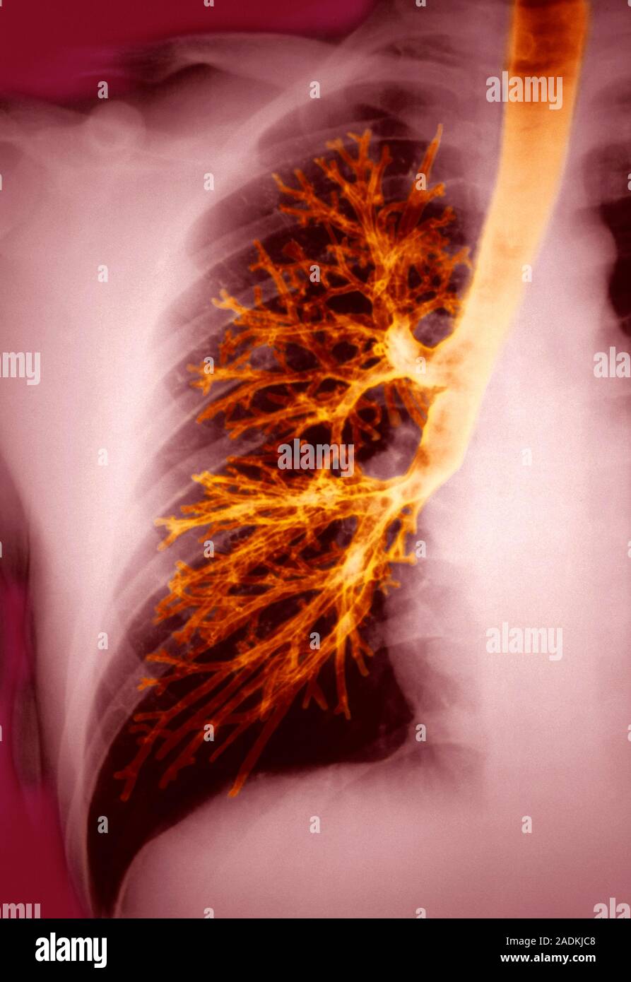 Lung. Coloured bronchography (X-ray) of a healthy human lung. A ...