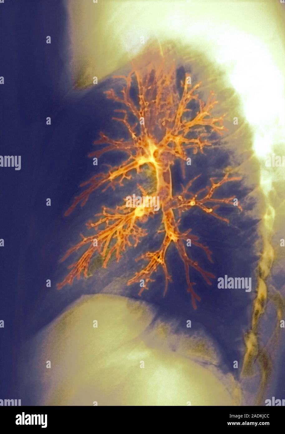 Lung. Coloured bronchography (X-ray) of a lateral (side) view of a ...