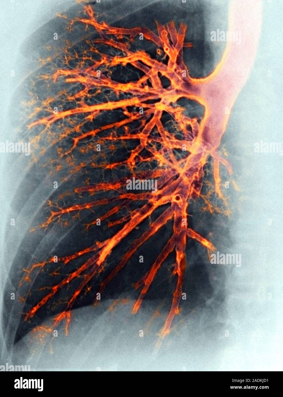 Lung. Coloured bronchography (X-ray) of a healthy human lung. A ...