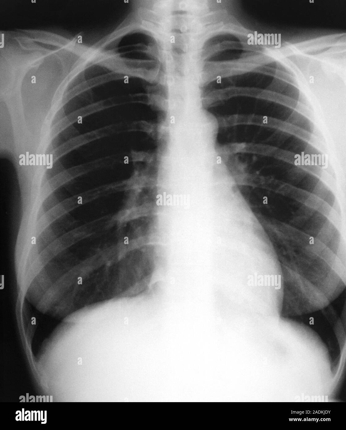 X-ray photograph of a normal human chest showing the heart (opaque ...