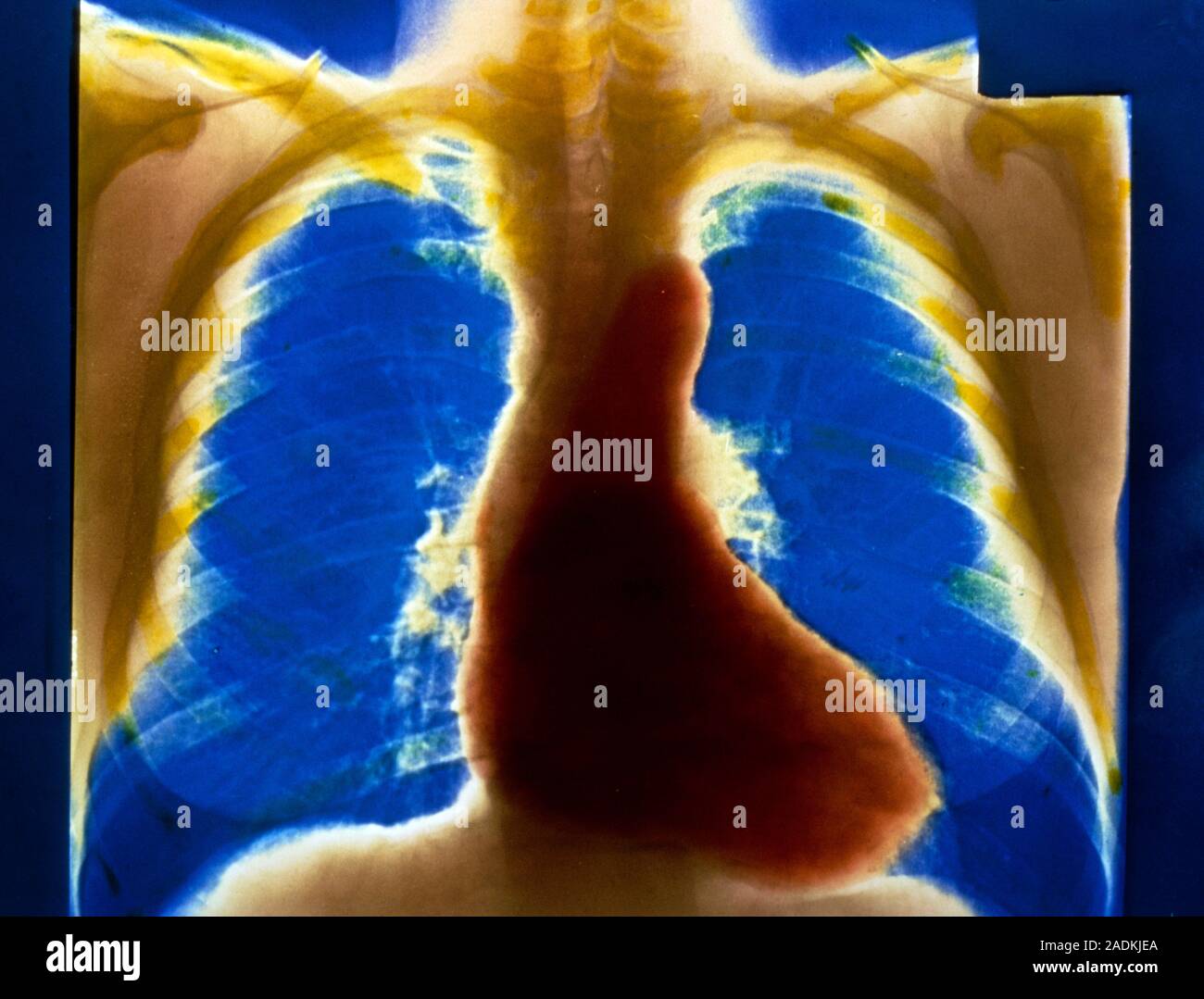 False-colour normal chest X-ray, showing a normal heart (protruding to ...