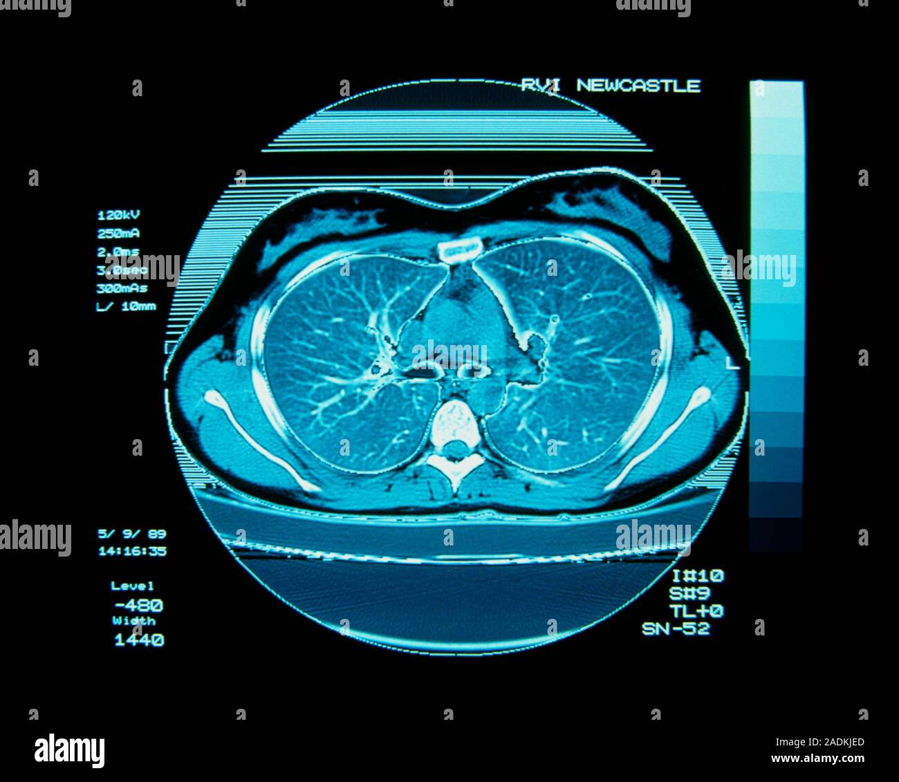 Computed X-ray tomography (CT) scan of the chest of a healthy woman ...
