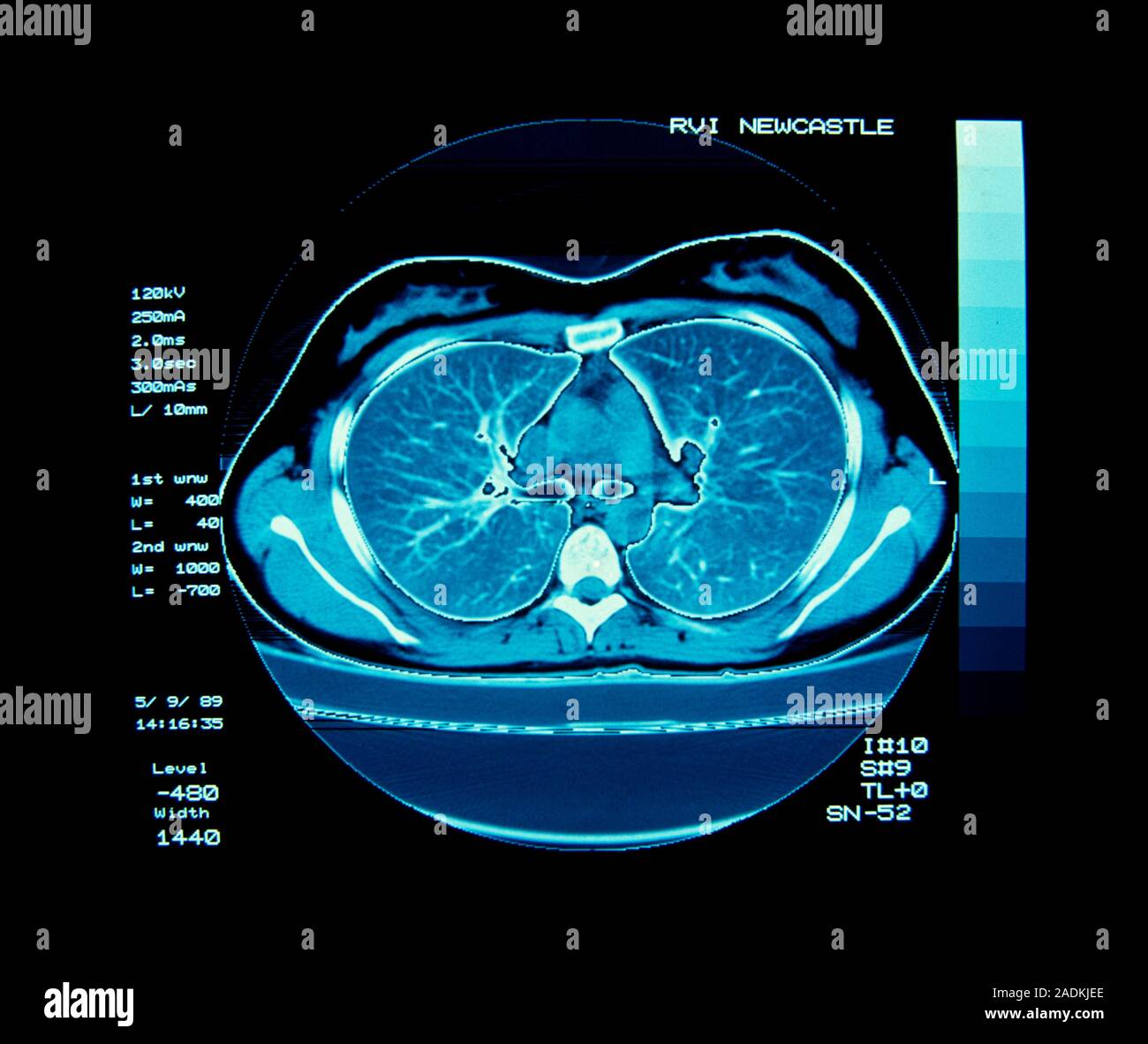 Computed X-ray tomography (CT) scan of the chest of a healthy woman ...