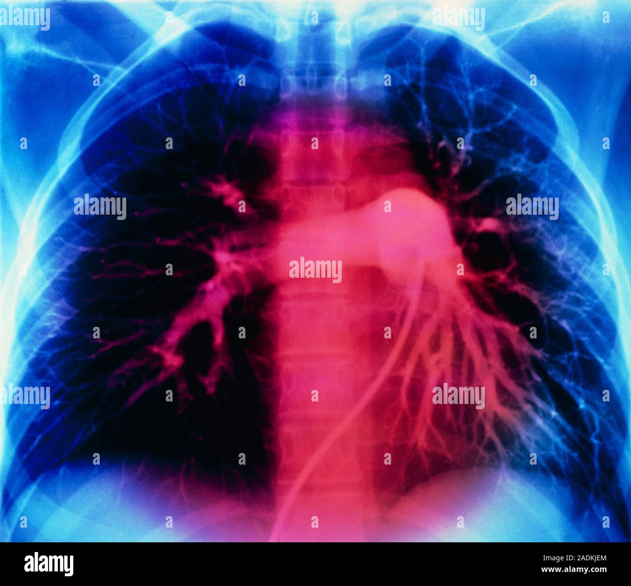 False-colour normal pulmonary arteriogram. Arteriography (or ...
