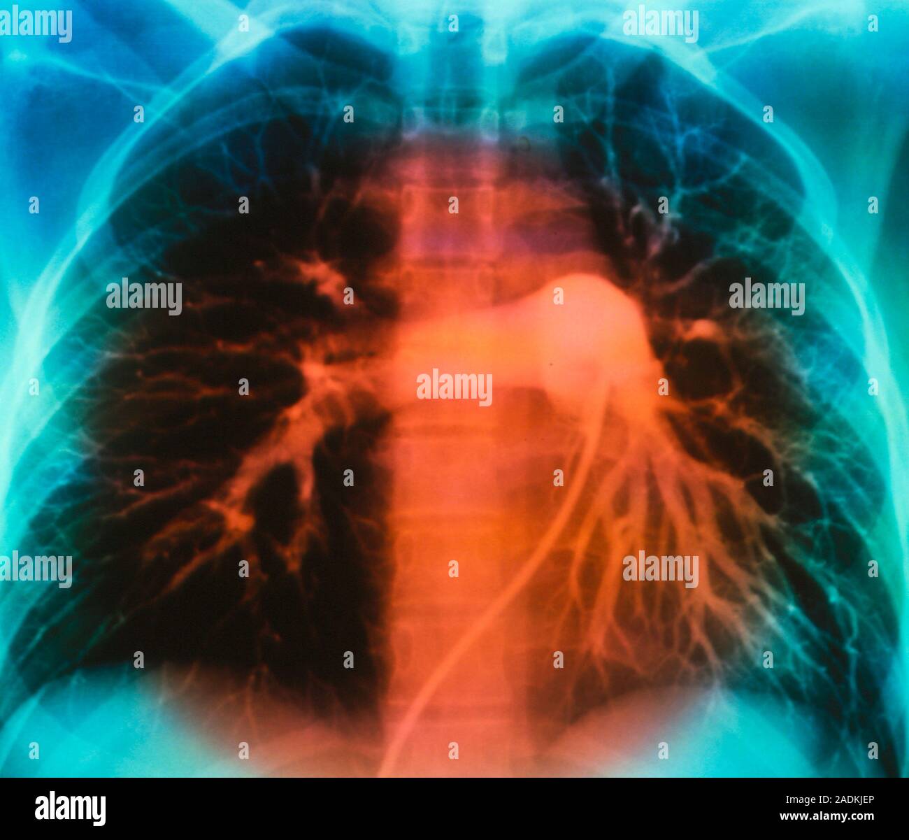 False-colour normal pulmonary arteriogram. Arteriography (or ...