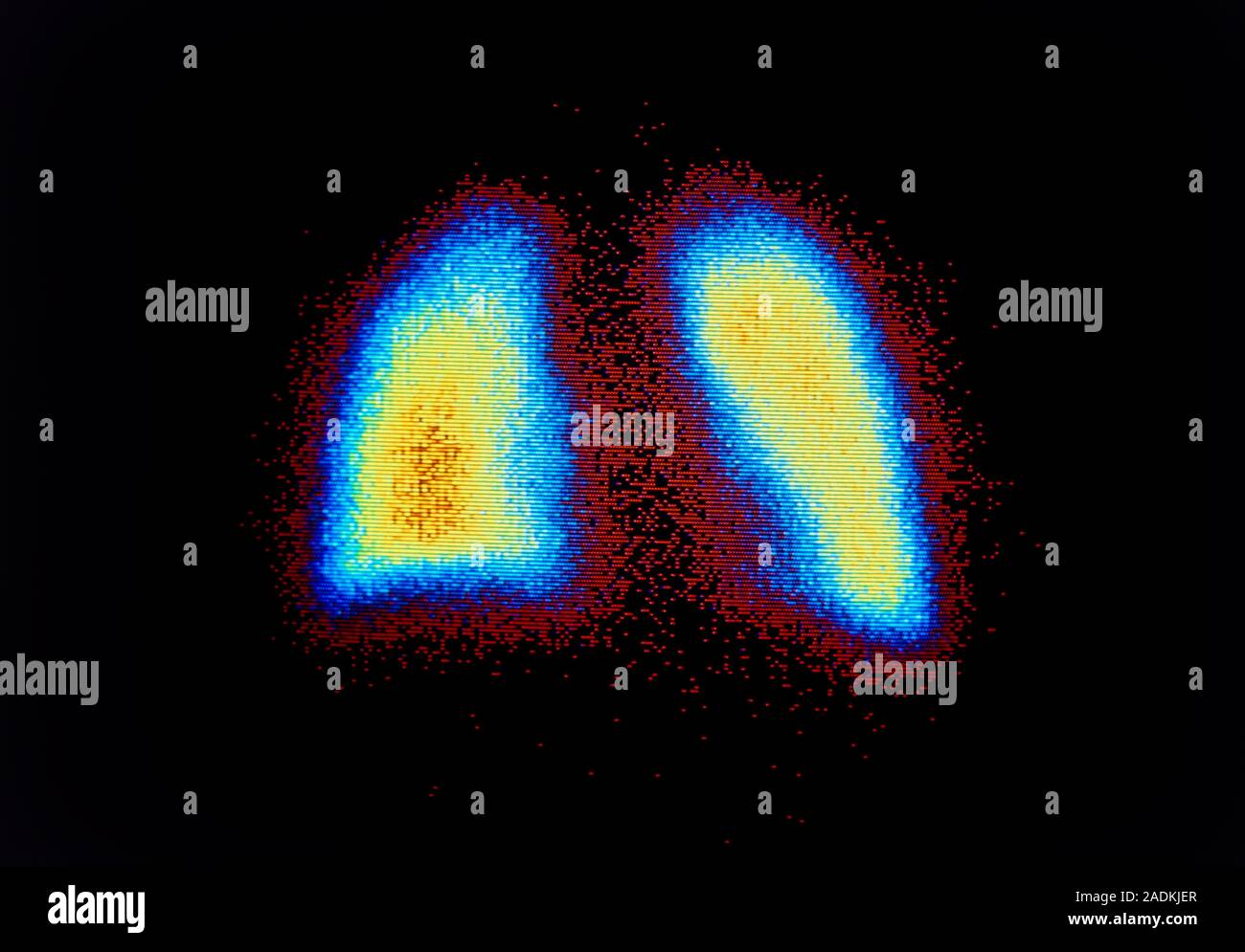 False-colour gamma camera scan (scintigram) showing the blood ...