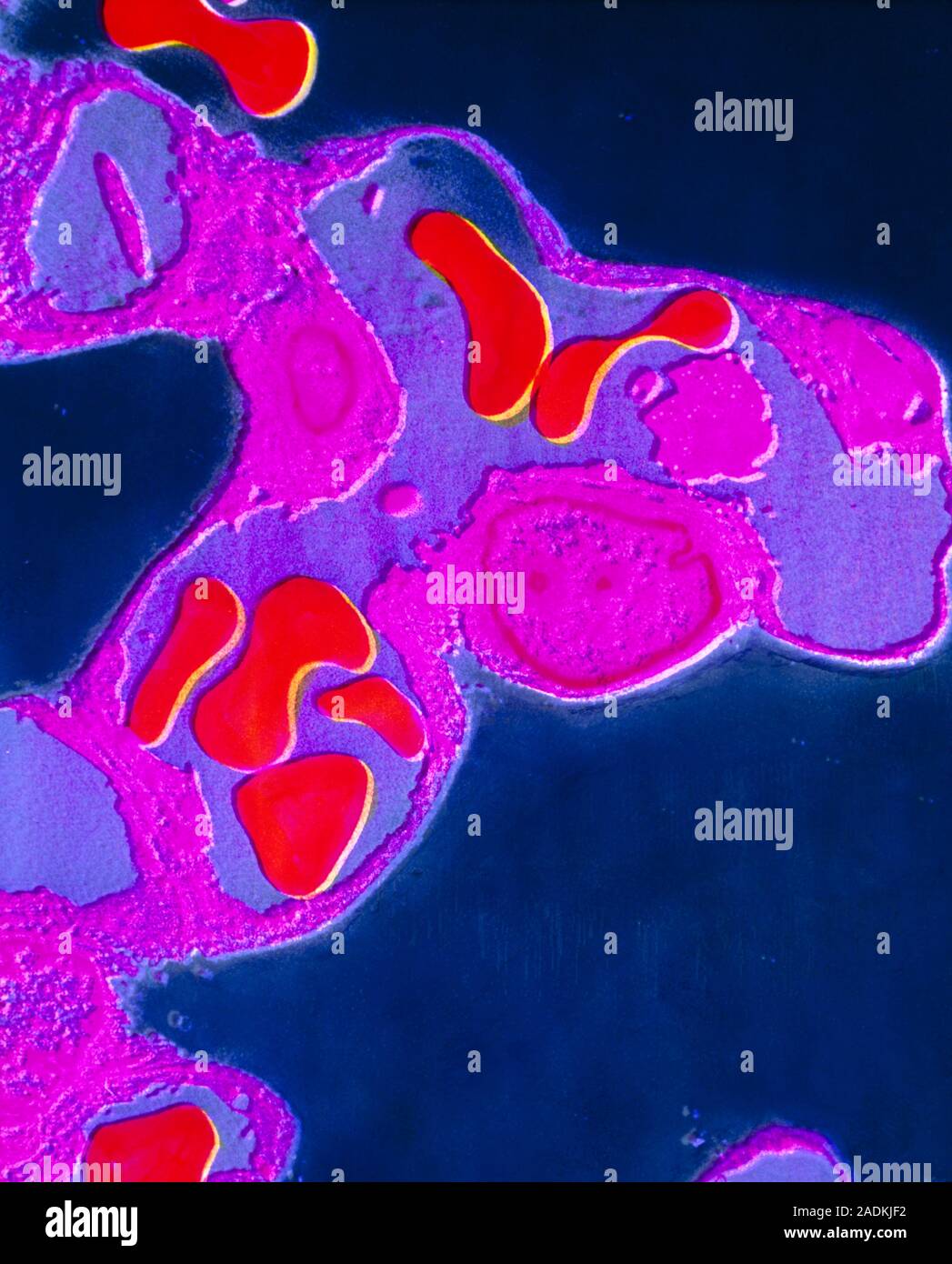 False-colour transmission electron micrograph (TEM) of human lung ...