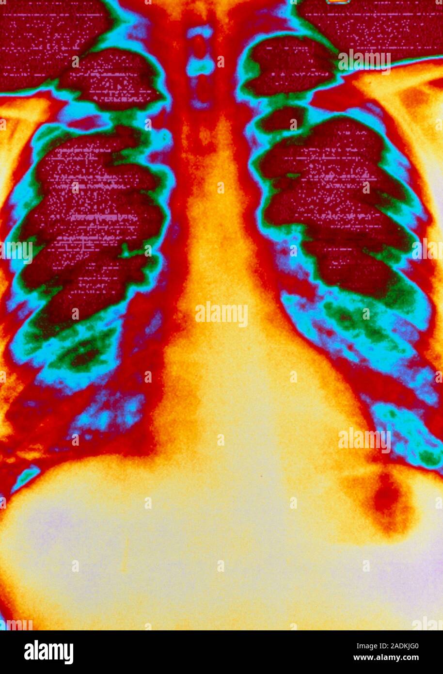 Coloured X-ray showing the lungs (red with blue- green contours) of a ...