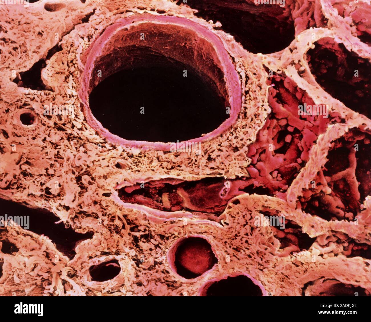 Lung tissue. Coloured scanning electron micrograph of human lung tissue ...