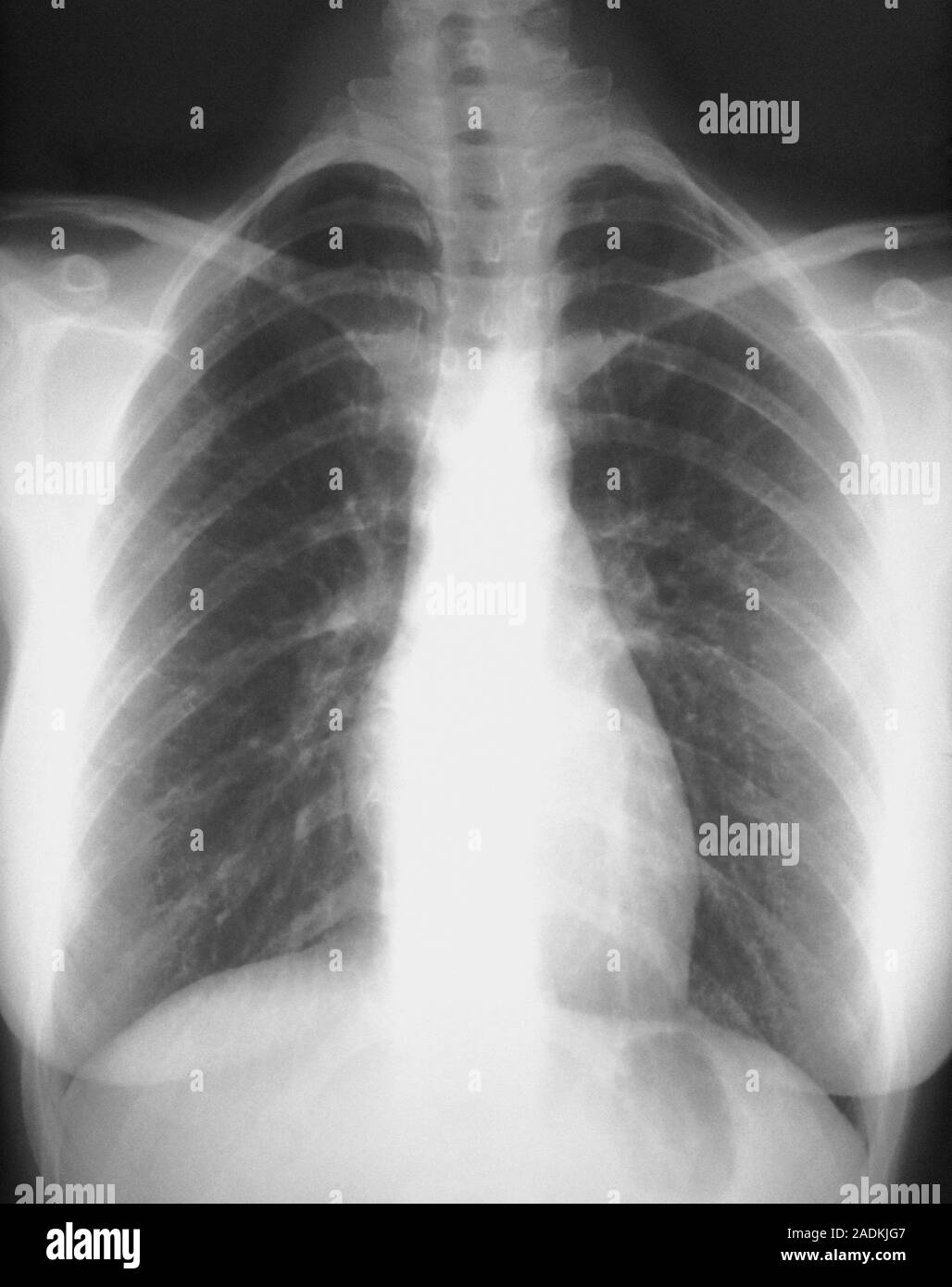 Healthy lungs and heart. X-ray of the human chest, showing normal lungs ...