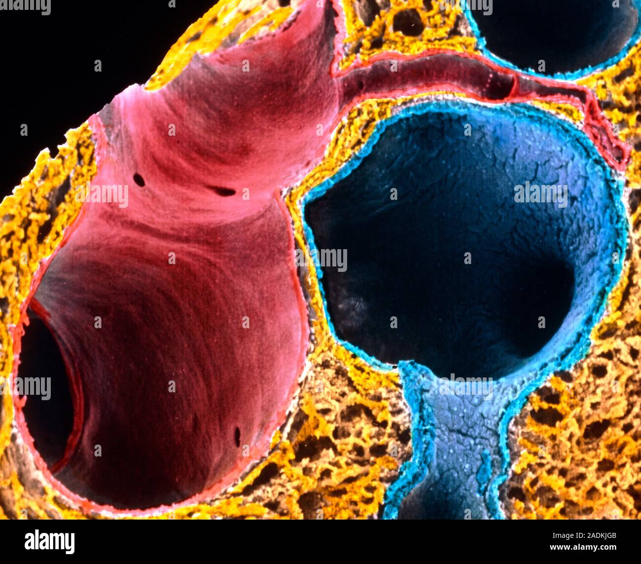 Lung alveoli and bronchus. Coloured Scanning Electron Micrograph (SEM ...