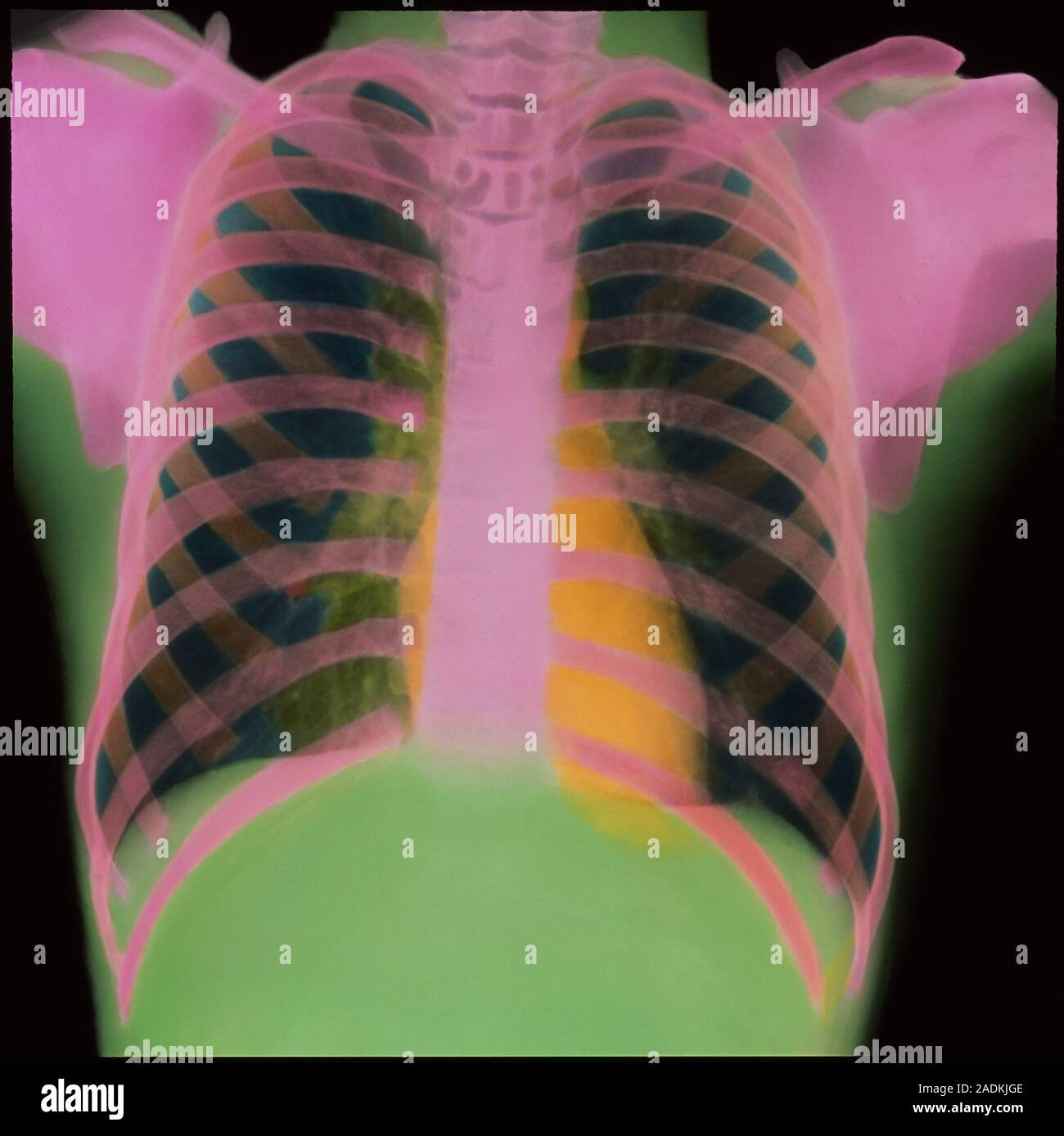 Healthy lungs and heart. Coloured X-ray of the chest of an 11-year-old ...