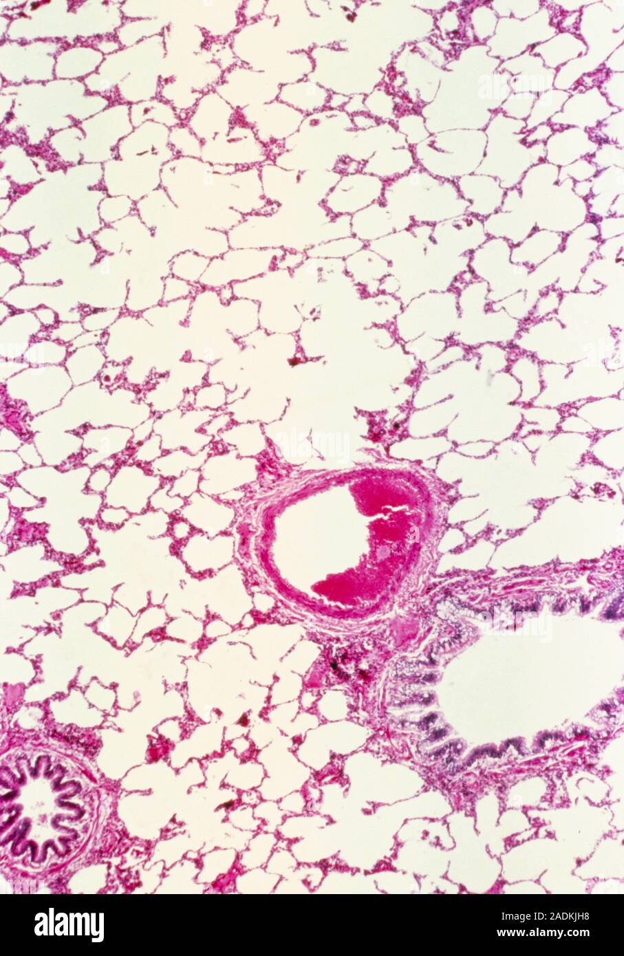 Lung tissue. Light micrograph of a cross section through lung tissue ...