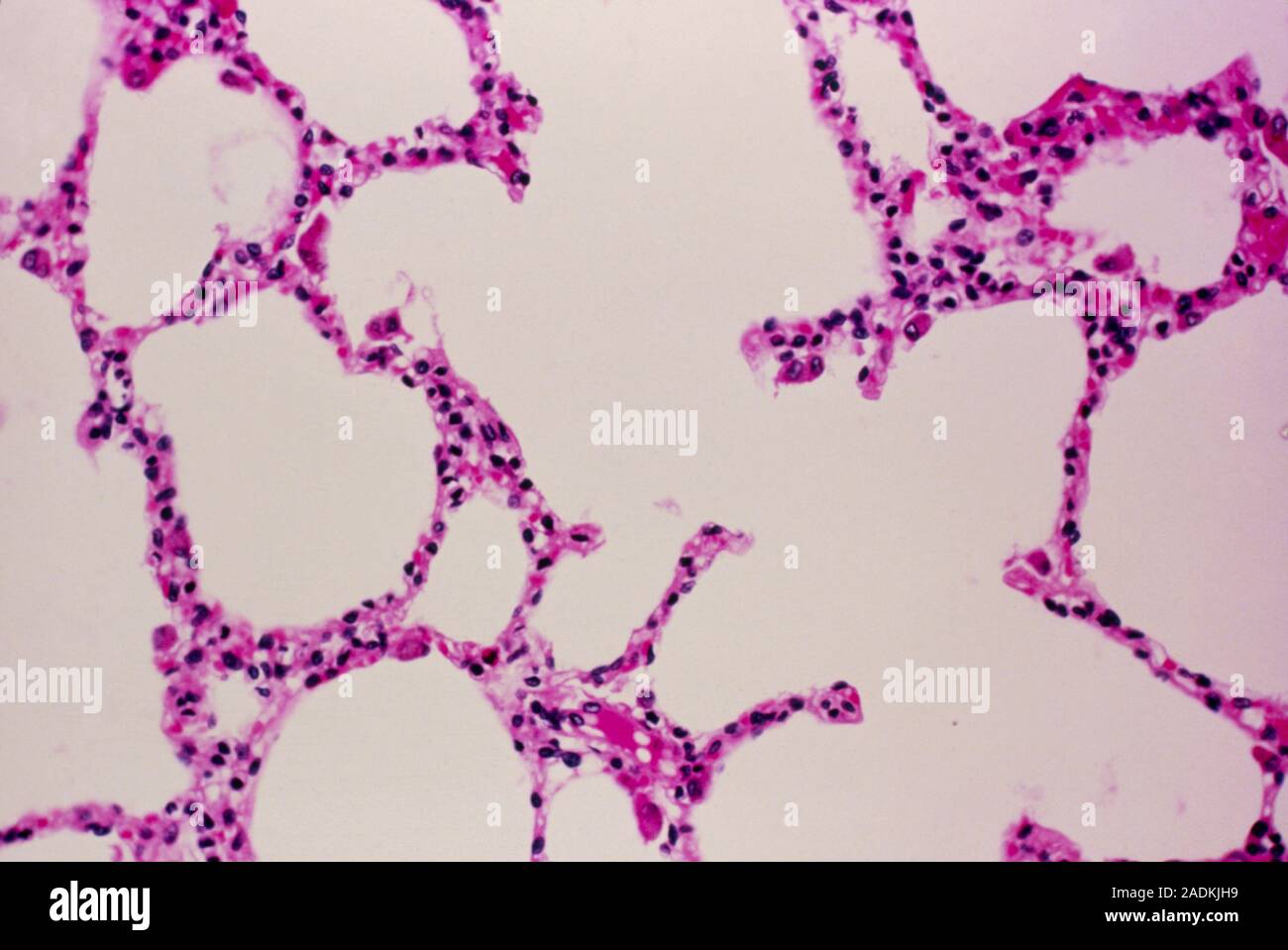 Lung alveoli. Light micrograph of a cross section through lung tissue ...