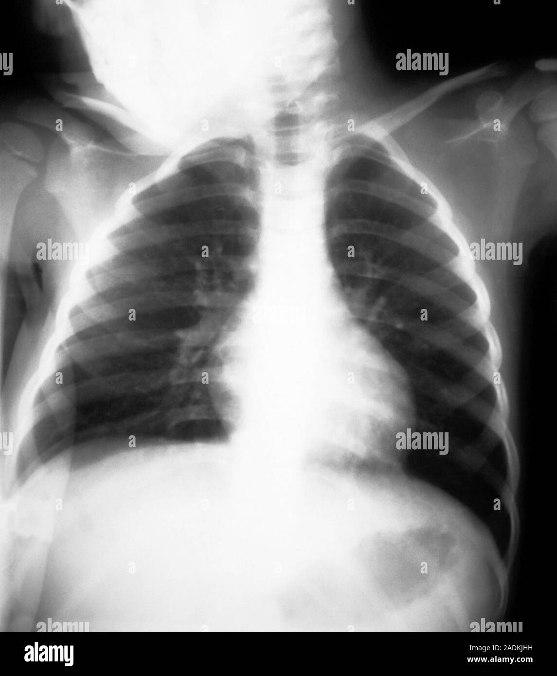 Healthy chest X-ray. X-ray of the chest of a healthy three year old ...