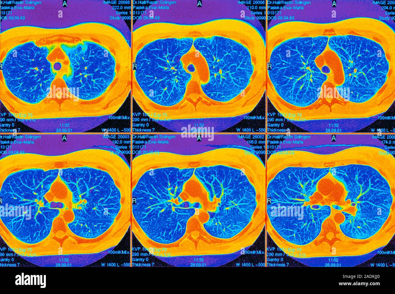 Lungs. Sequence of six coloured axial CT (computed tomography) scans through the upper chest of ...