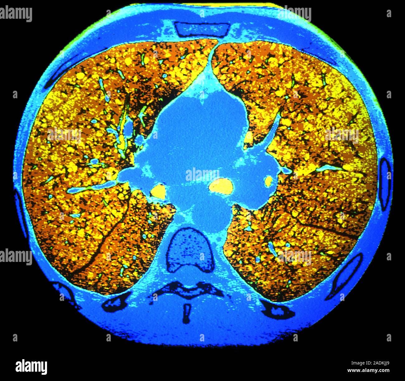 Lungs. Coloured computed tomography (CT) scan of an axial section through the thorax showing a ...