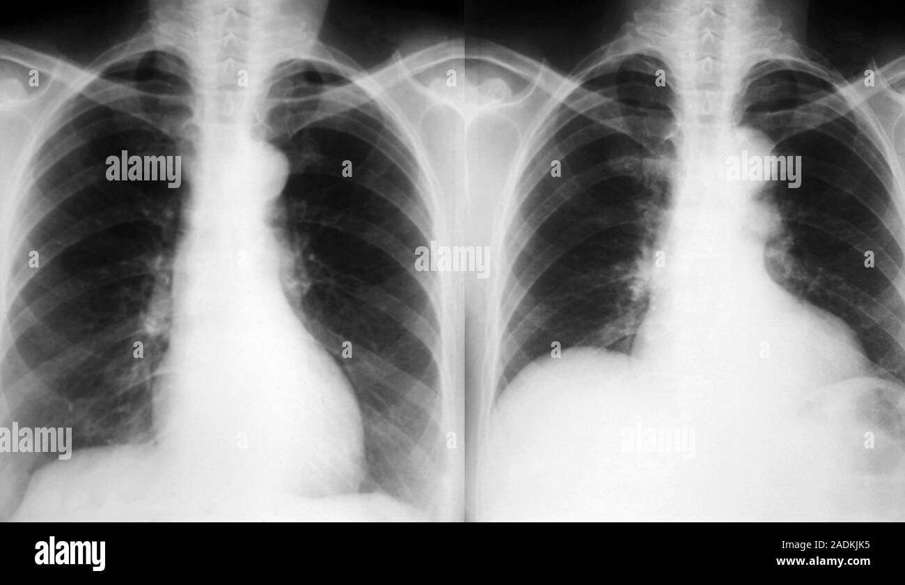 Breathing. X-ray showing inhalation (left) and exhalation (right). The ...