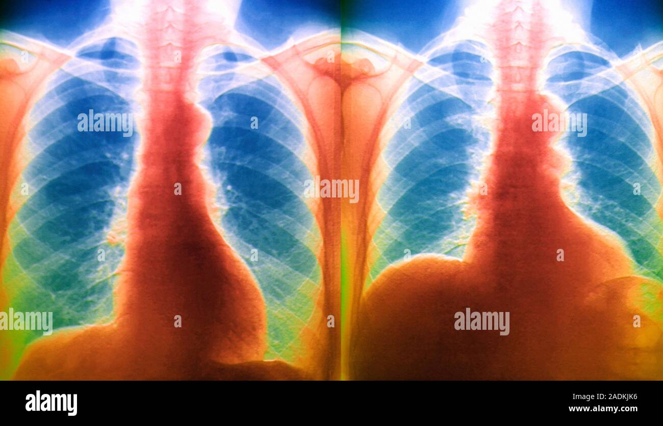 Breathing. Coloured X-ray showing inhalation (left) and exhalation ...