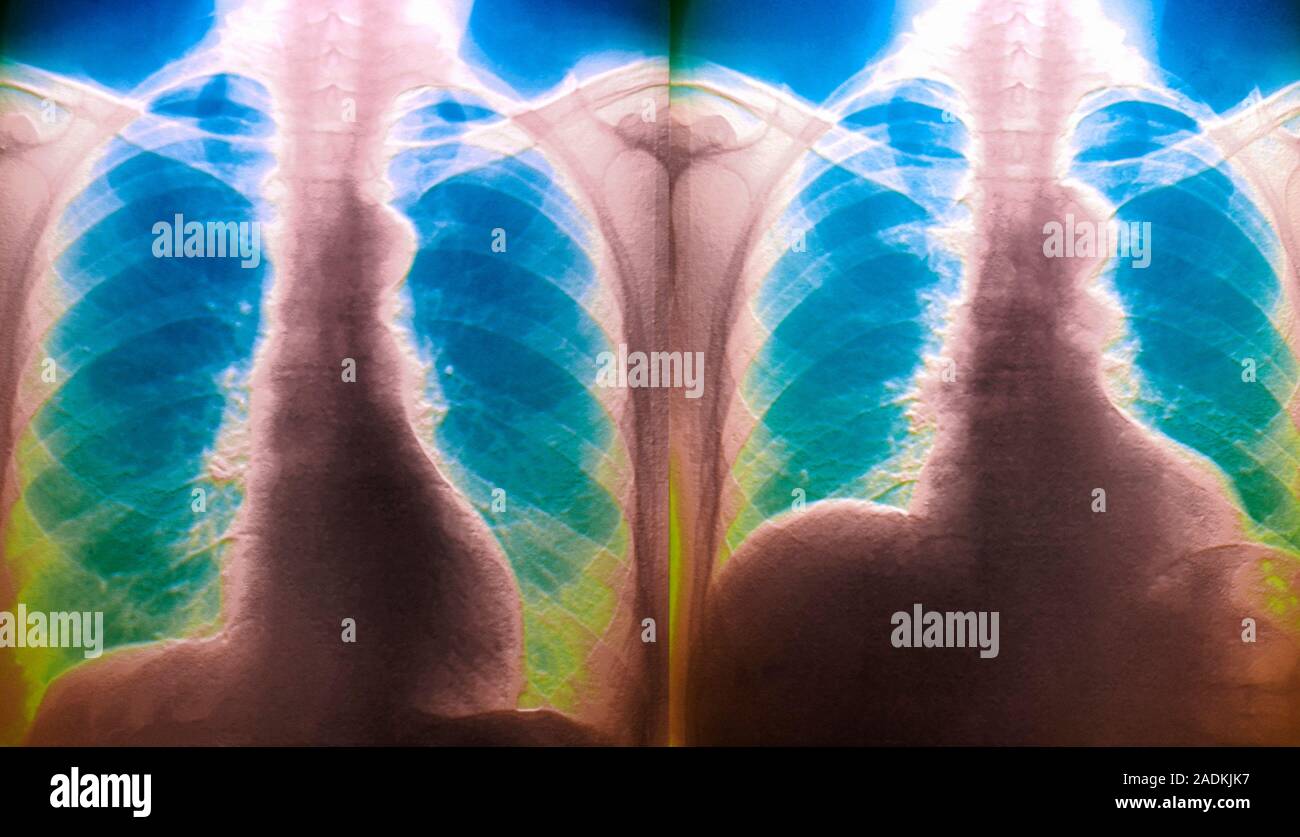 Breathing. Coloured X-ray showing inhalation (left) and exhalation ...