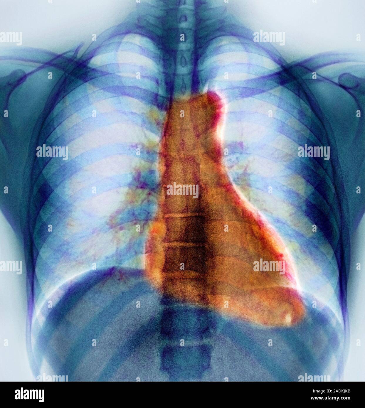 Breathing. Coloured X-ray showing exhalation. The horizontal bands are ...