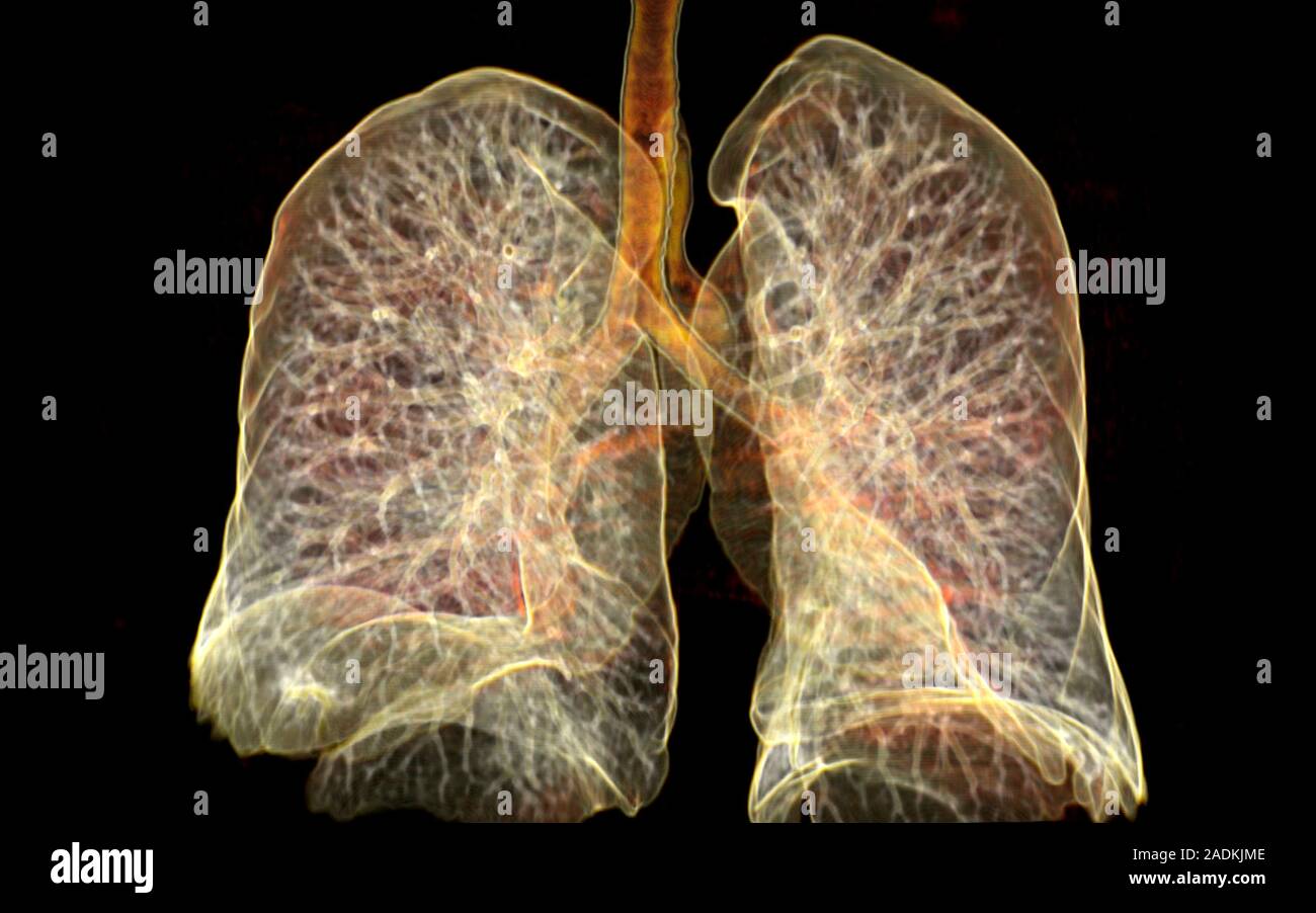 Lungs, CT scan. Coloured 3-D computed tomography (CT) scan of lungs in ...