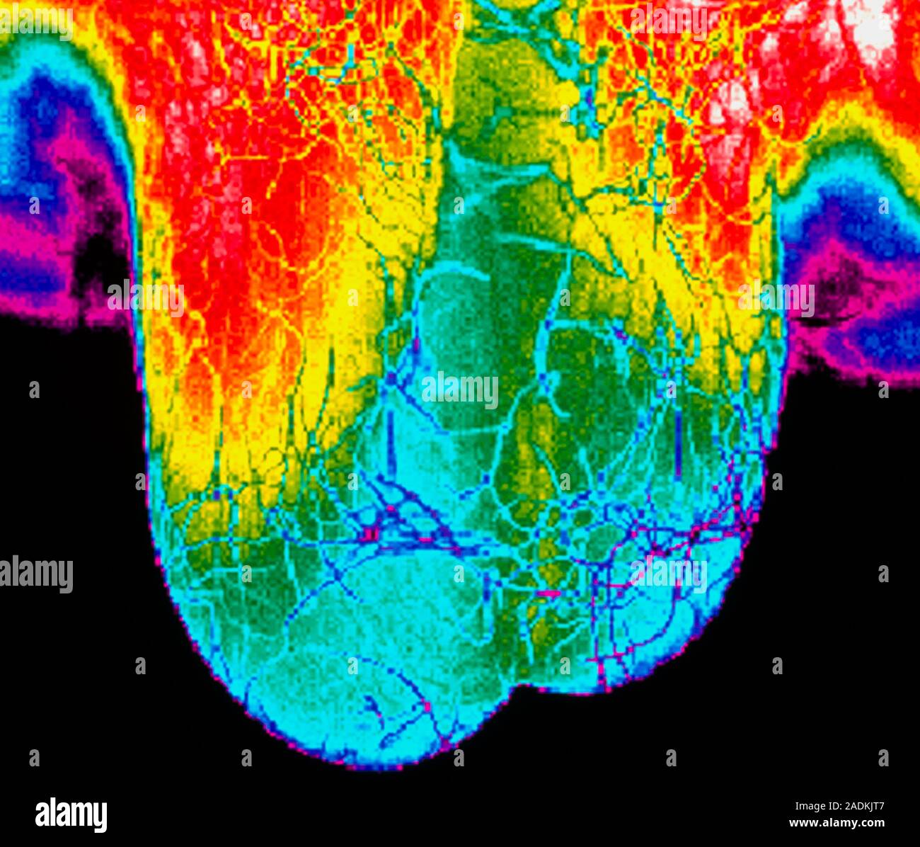 Scrotum. Thermogram of an anterior view of a healthy human scrotum. The ...
