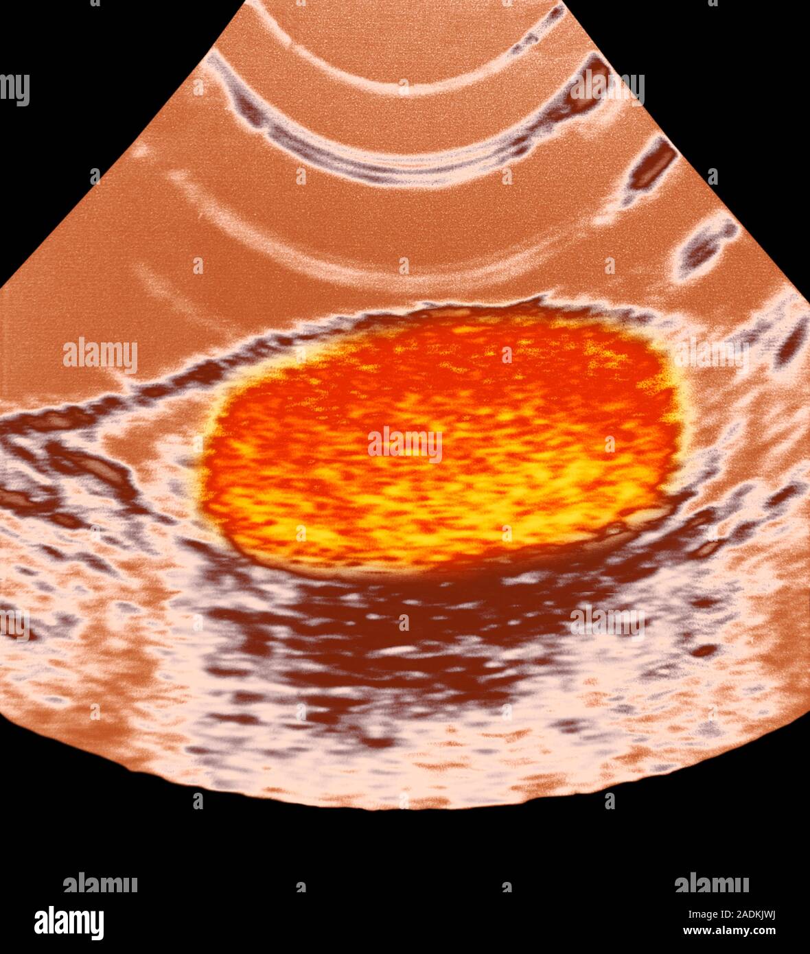 Human testis. Coloured ultrasound scan of a healthy testis (orange) of ...