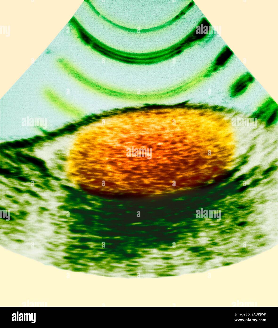 Human testis. Coloured ultrasound scan of a healthy testis (yellow) of ...