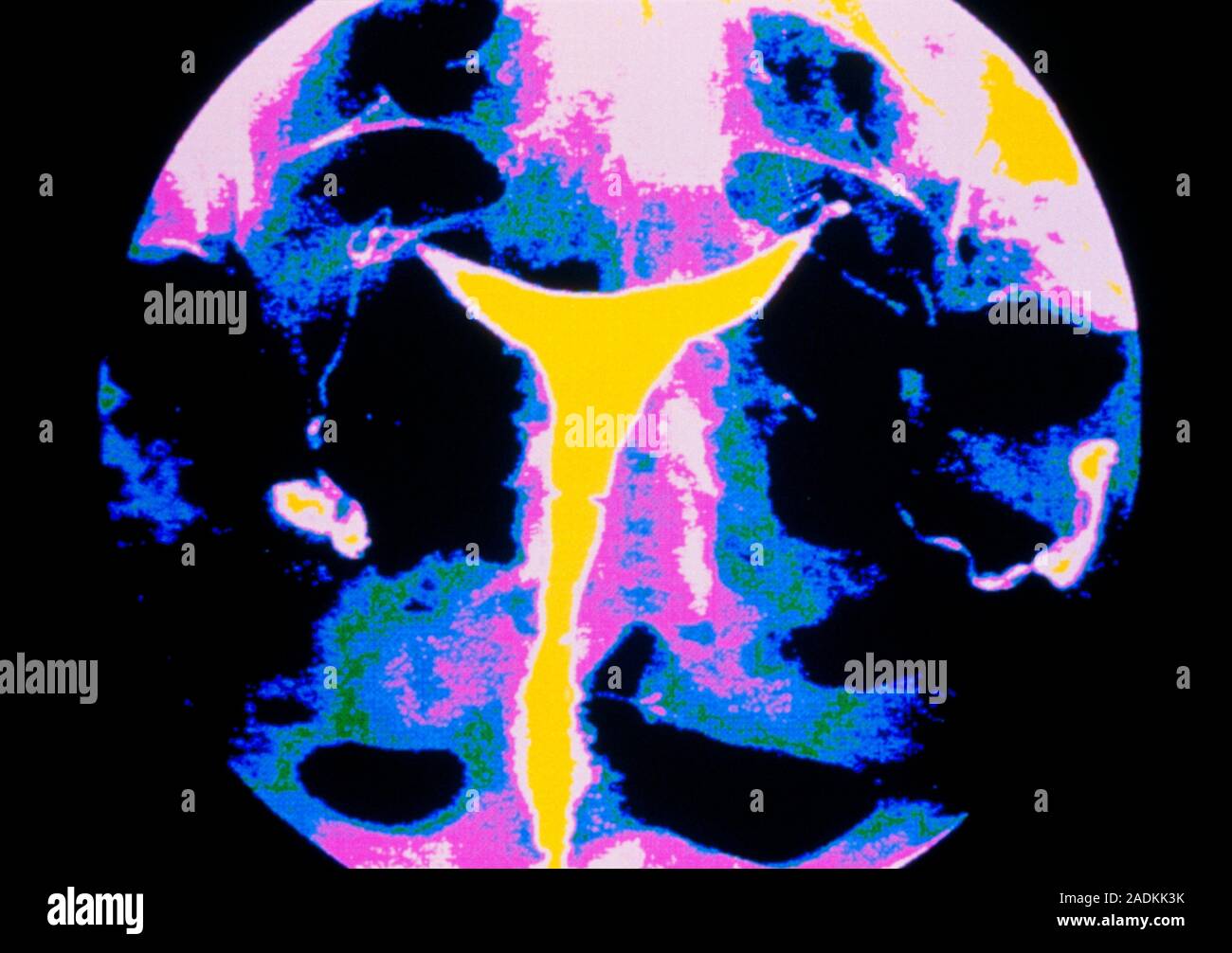 Female reproductive organs. Coloured X-ray hyster- osalpingogram of a ...