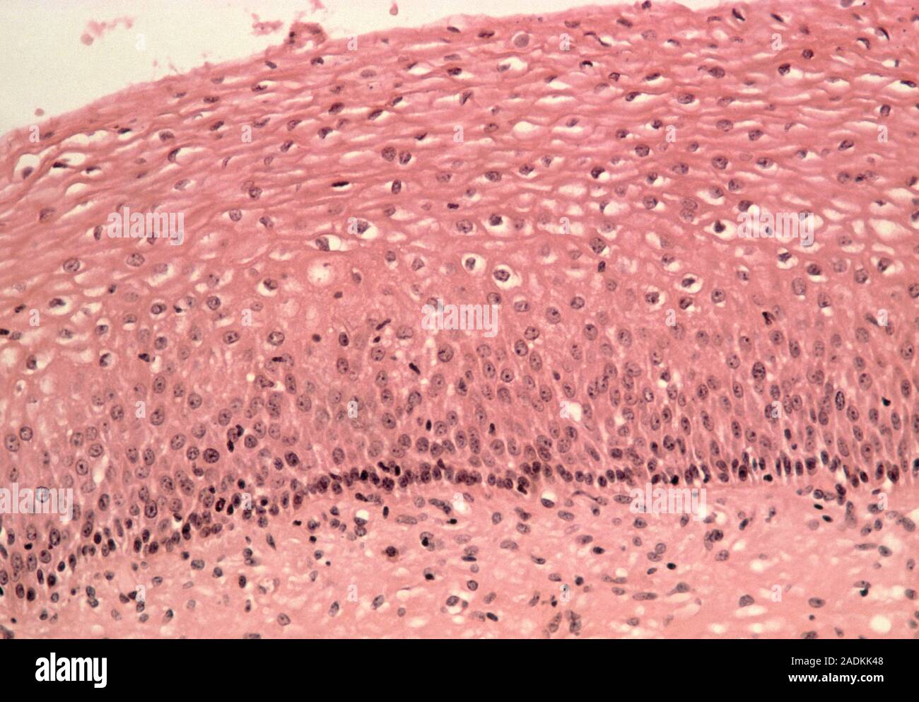 Cervical Epithelium Light Micrograph Of A Section Through The Epithelium Of A Biopsy Taken From
