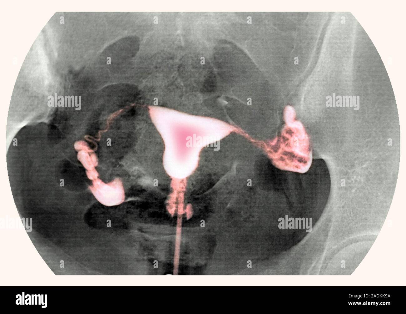 Female reproductive organs, coloured X-ray. This is a ...
