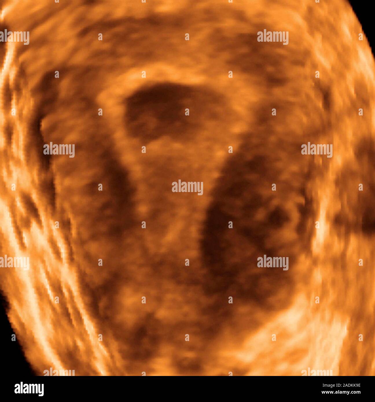 Uterus. Coloured 3-D ultrasound scan of a healthy human uterus (centre ...