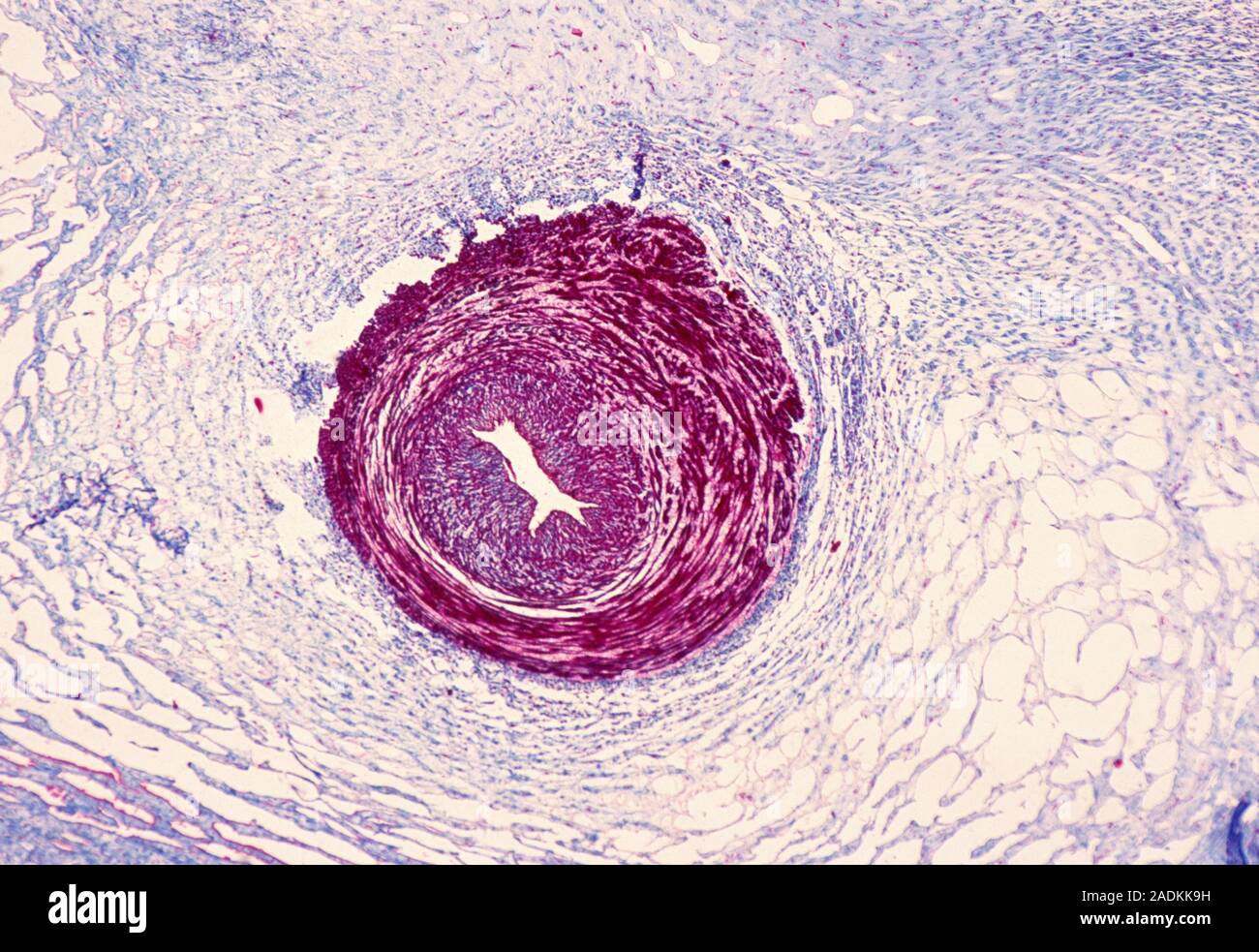 Umbilical cord. Light micrograph (LM) of a section through a human ...