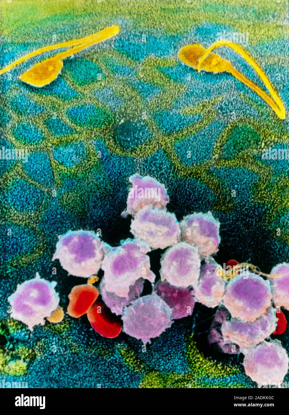 The death of sperm. Coloured scanning electron micrograph of two ...