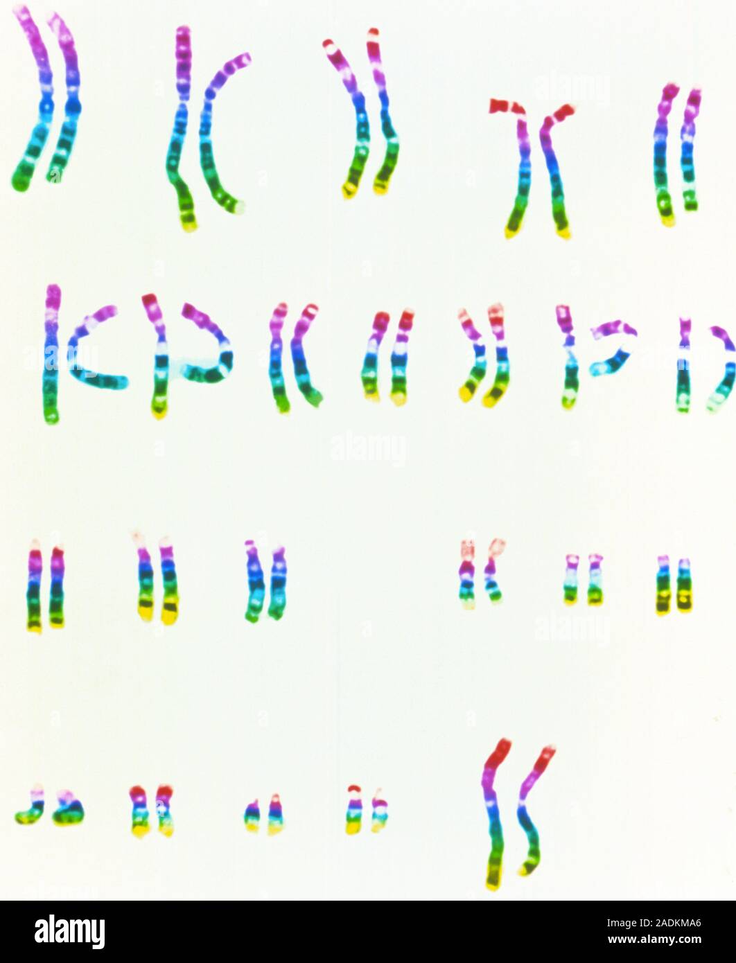 Female chromosomes. Light micrograph of a normal female karyotype, the ...