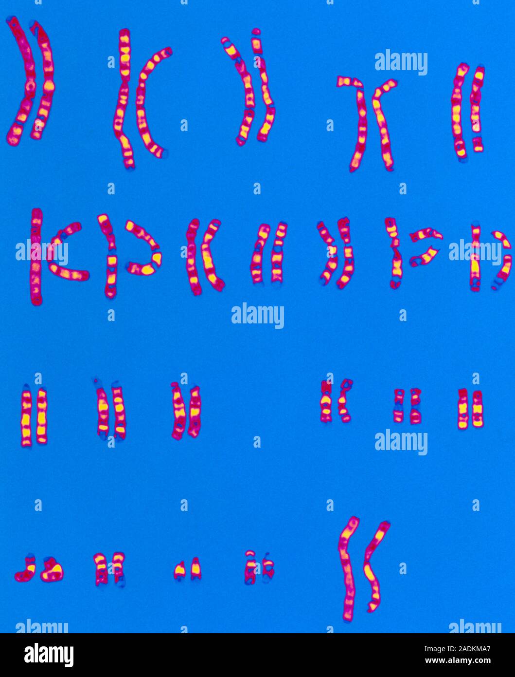 Female chromosomes. Light micrograph of a normal female karyotype, the ...