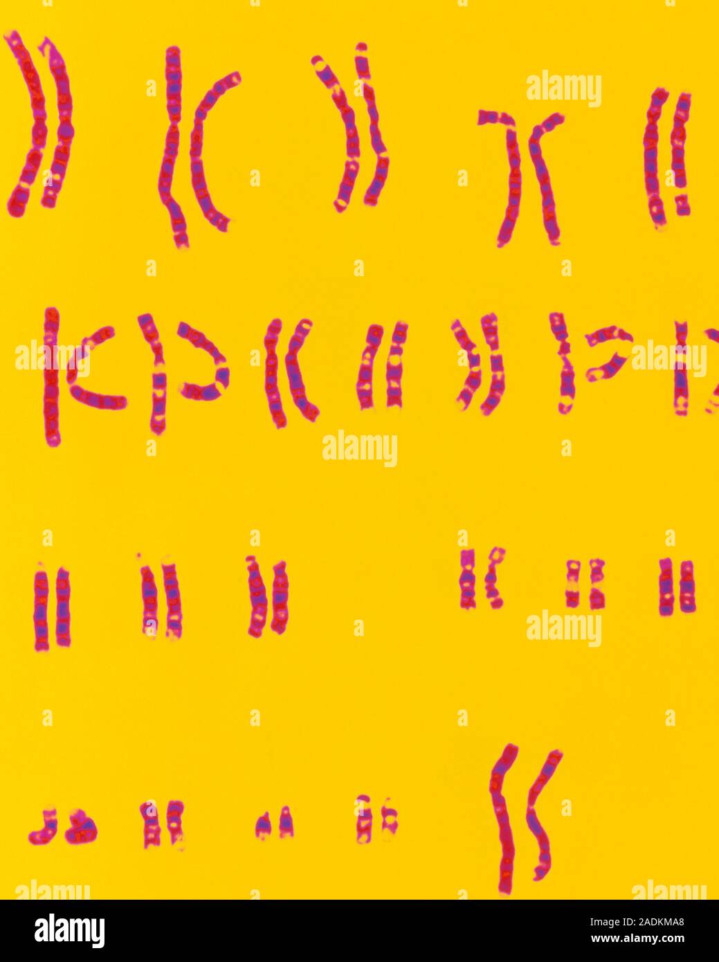 Female chromosomes. Light micrograph of a normal female karyotype, the ...