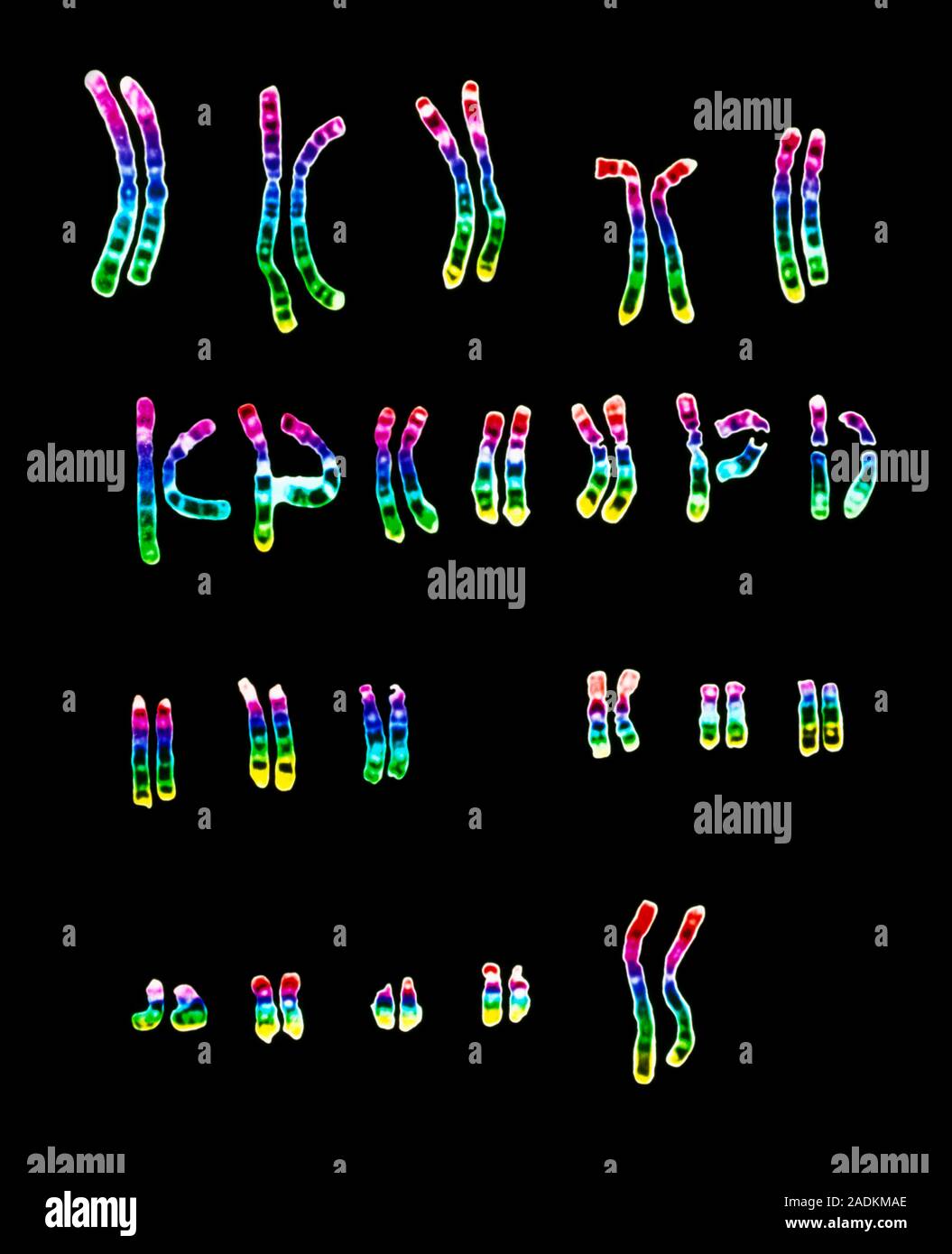 Female chromosomes. Light micrograph of a normal female karyotype, the ...