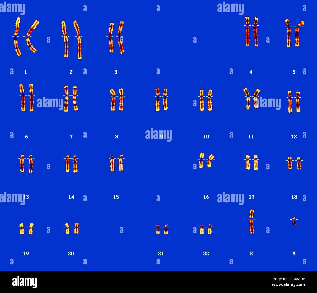 Male karyotype. Coloured image of a normal male karyotype (set of ...