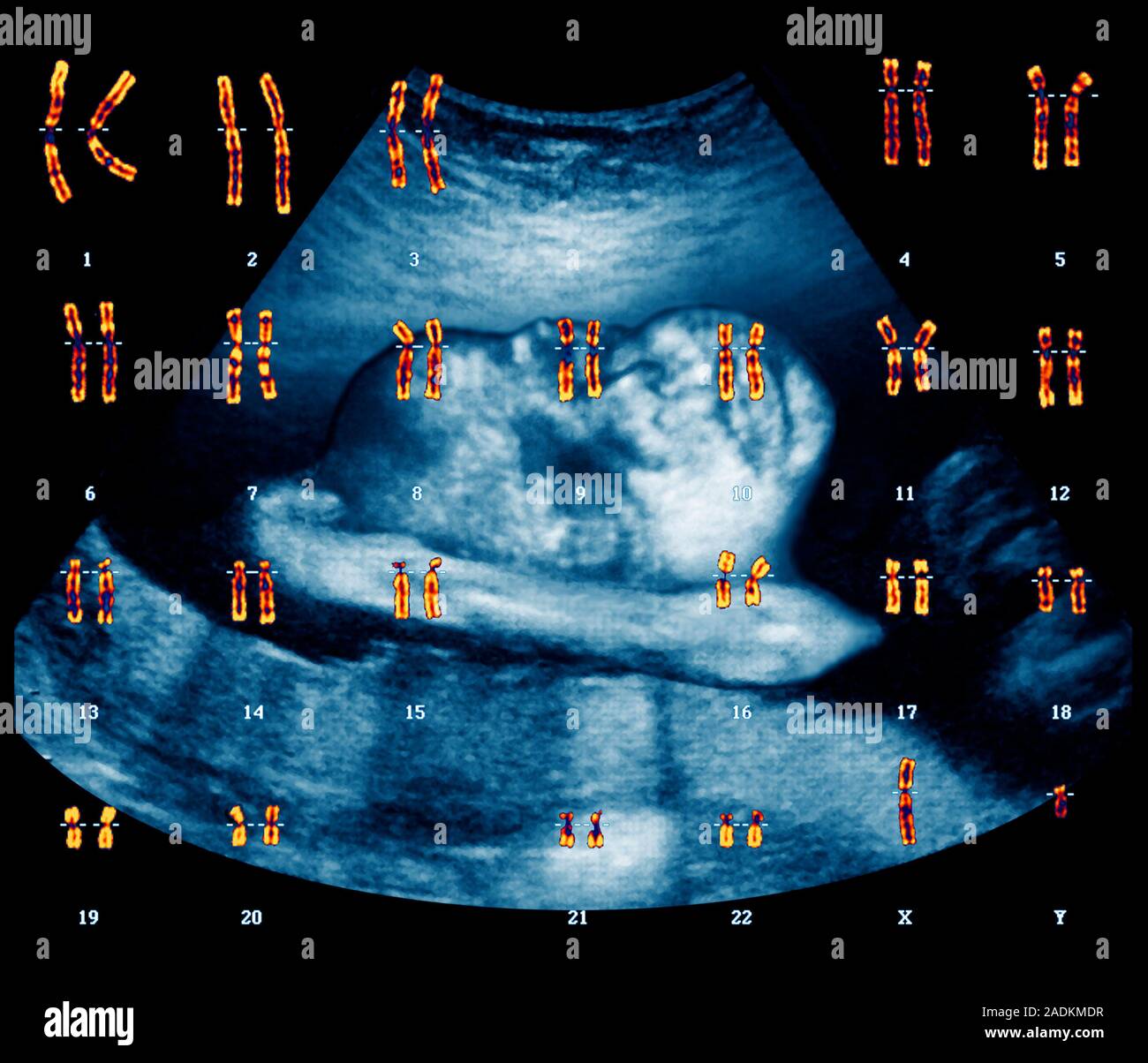 Baby gender determination. Coloured conceptual image of a normal male ...