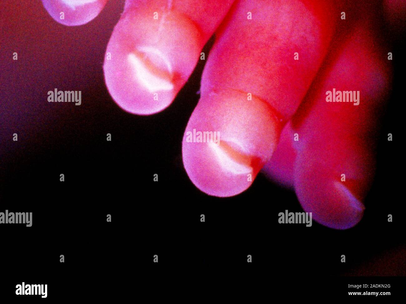 The human foetus after 5-6 months, showing a close-up of the fingers ...