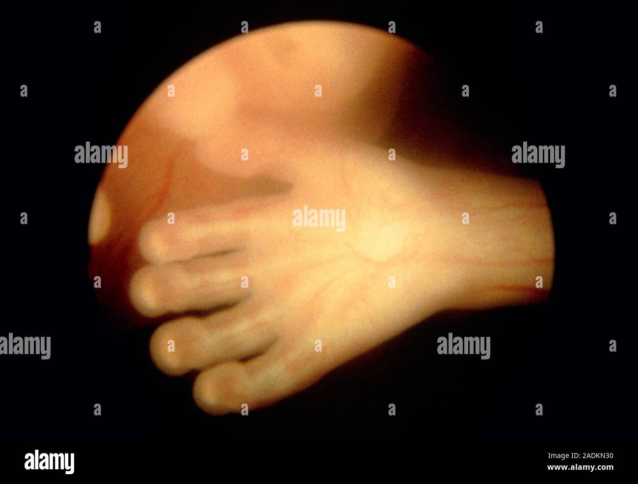 Endoscope image of the human foetus in the womb after approximately 3 ...
