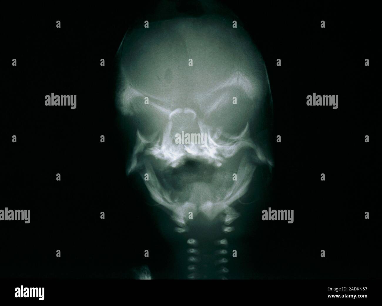 X-ray of the skull of an aborted 18-week fetus showing a cleft palate ...