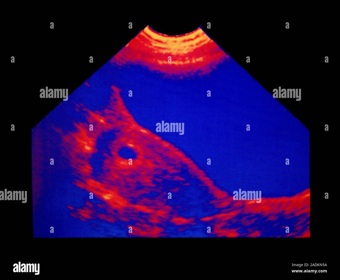 Early pregnancy: coloured ultrasound scan showing the gestation sac ...