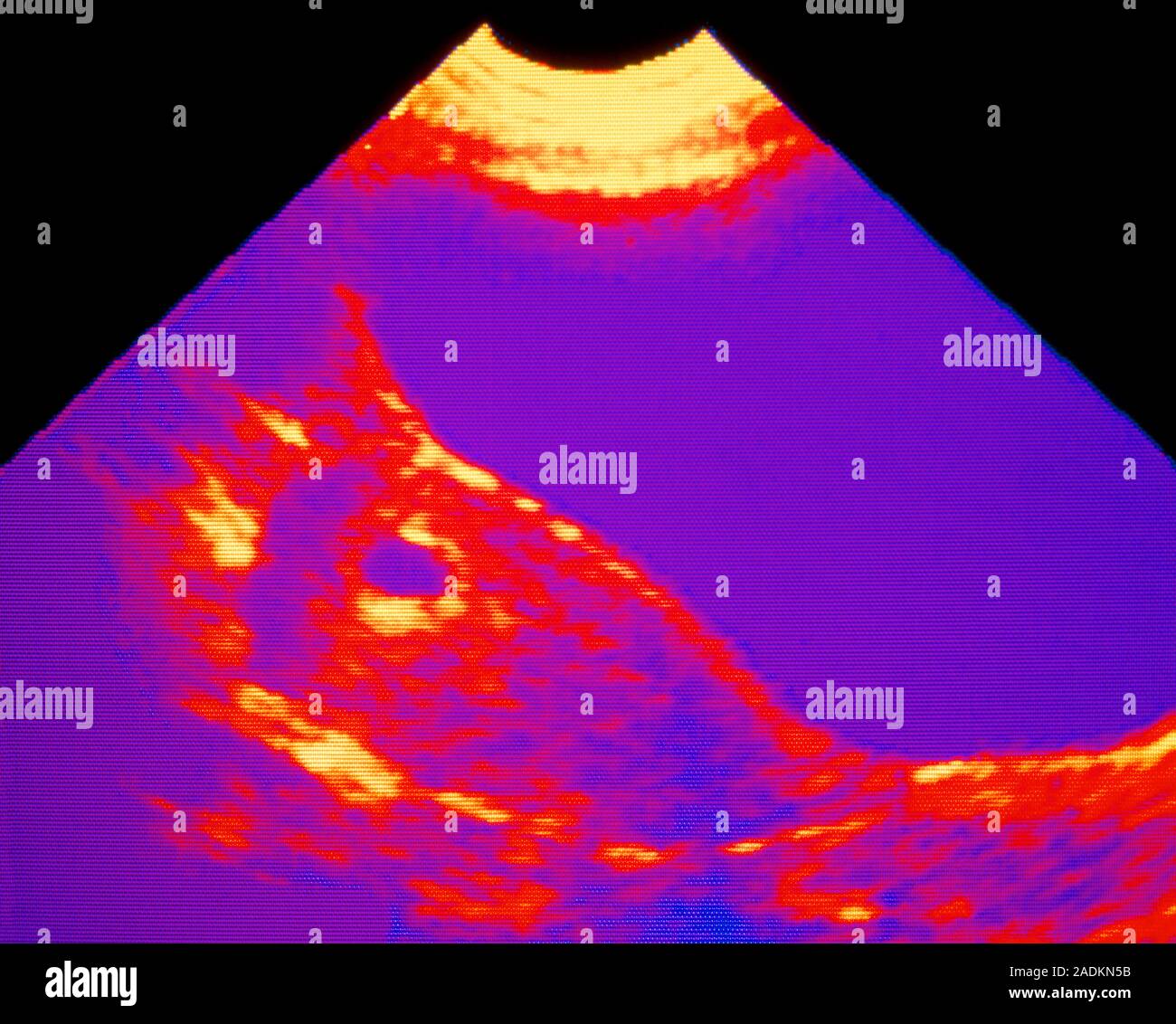 Early pregnancy: coloured ultrasound scan showing the gestation sac ...
