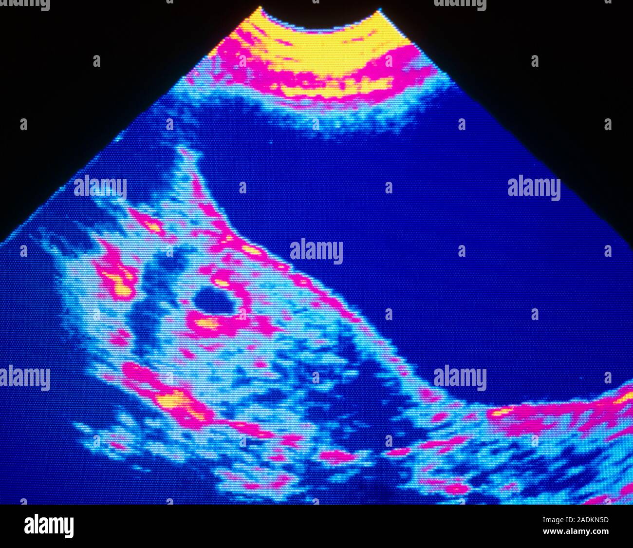 Early Pregnancy Coloured Ultrasound Scan Showing The Gestation Sac